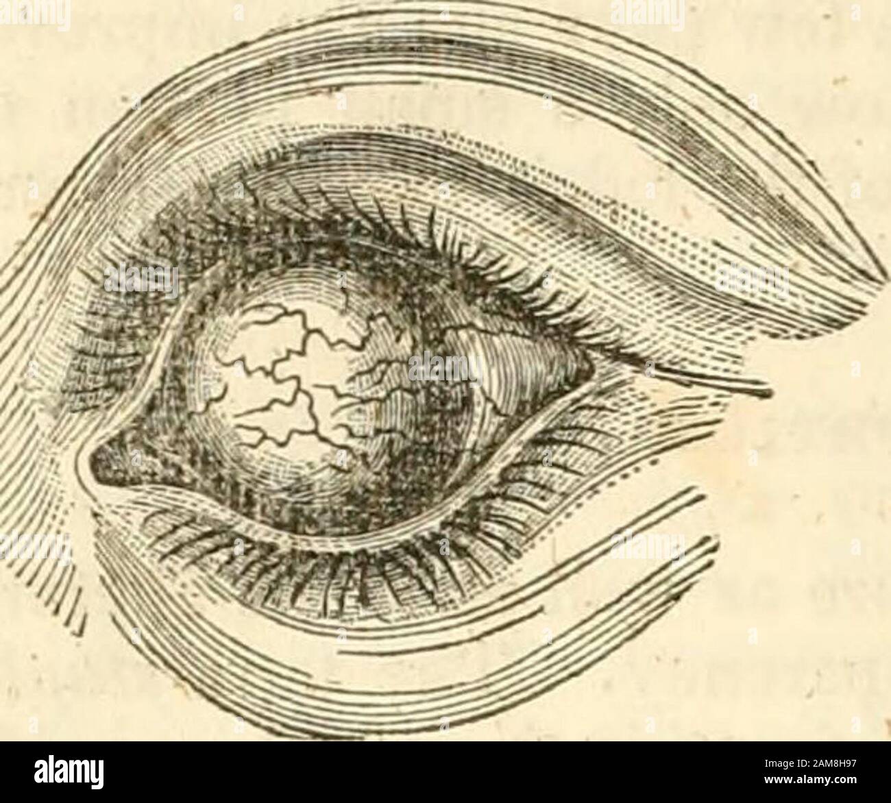 Staphyloma hi-res stock photography and images - Alamy