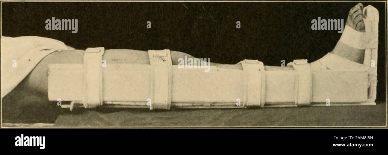 The treatment of fractures . Fig. 518.—The anterior wire suspensory ...