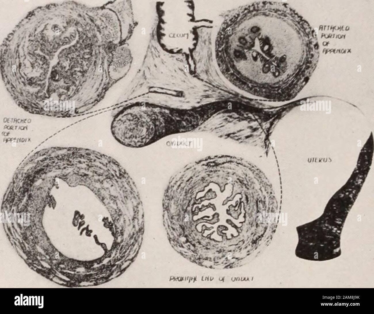 Deformed red blood cells hi-res stock photography and images - Alamy