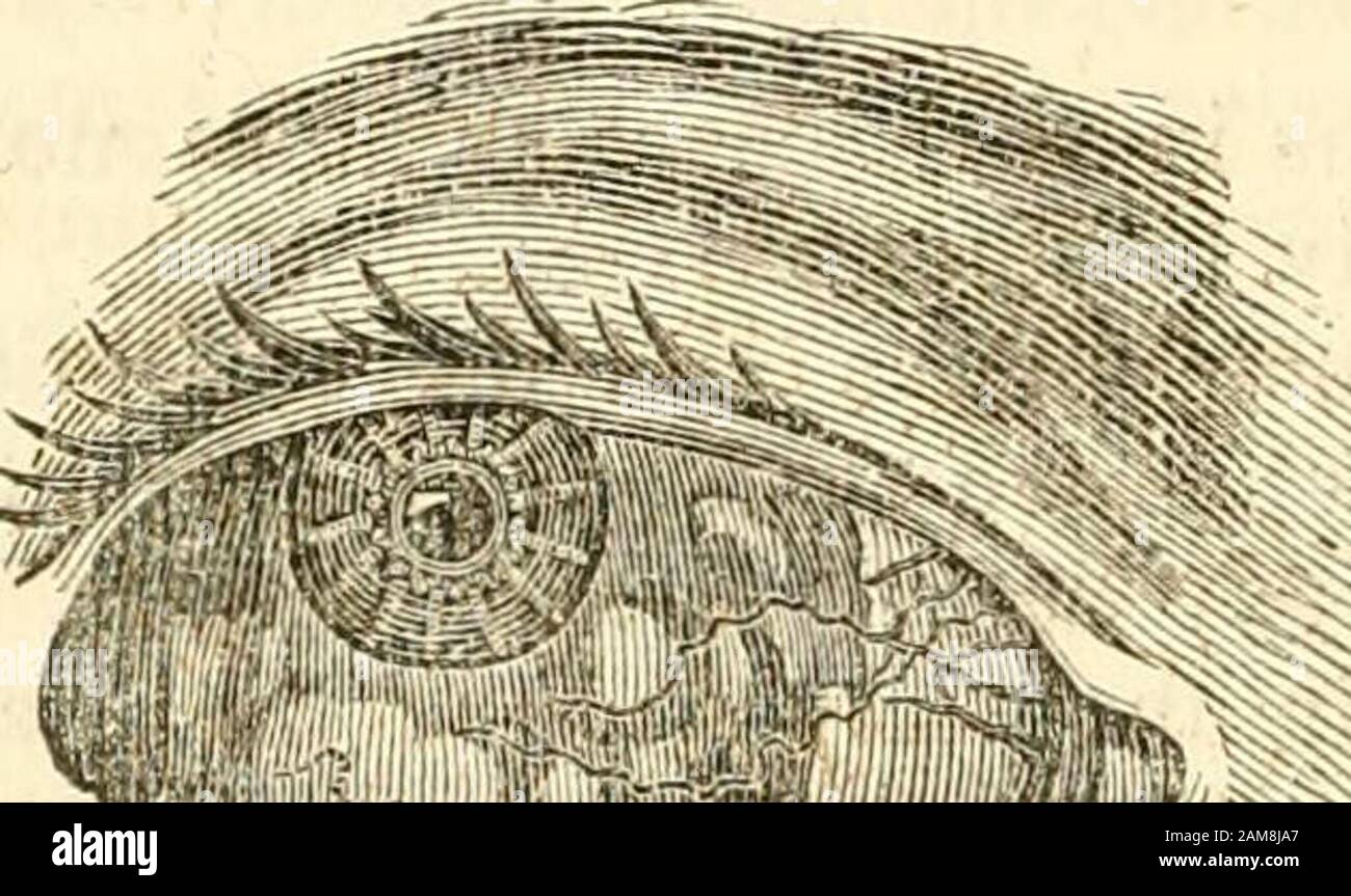 Chemosis hi-res stock photography and images - Alamy