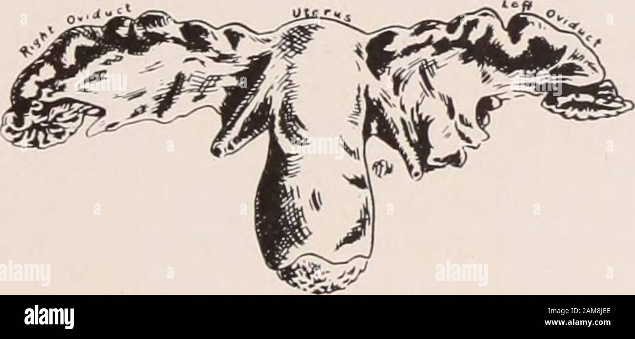 Hysterectomy drawing hi-res stock photography and images - Alamy