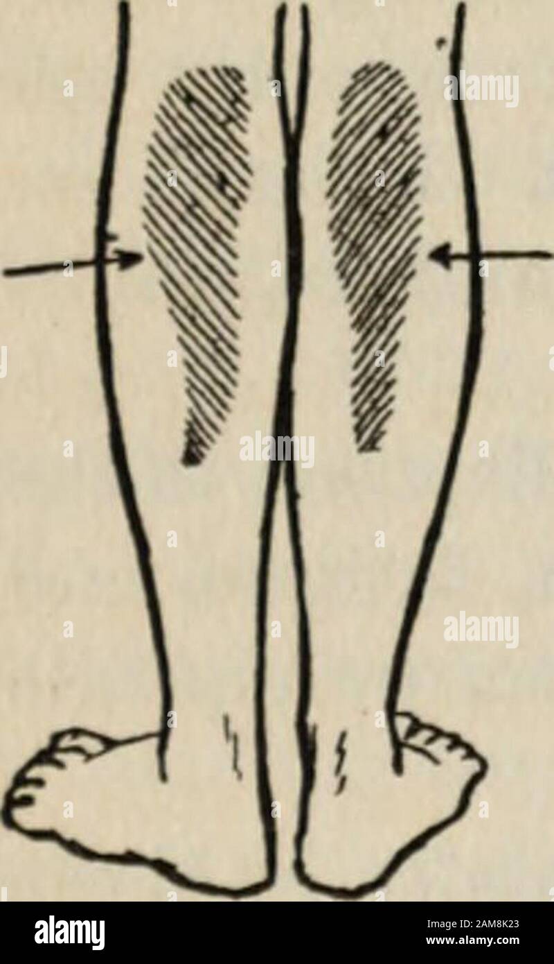 Attack of gout hi-res stock photography and images - Alamy