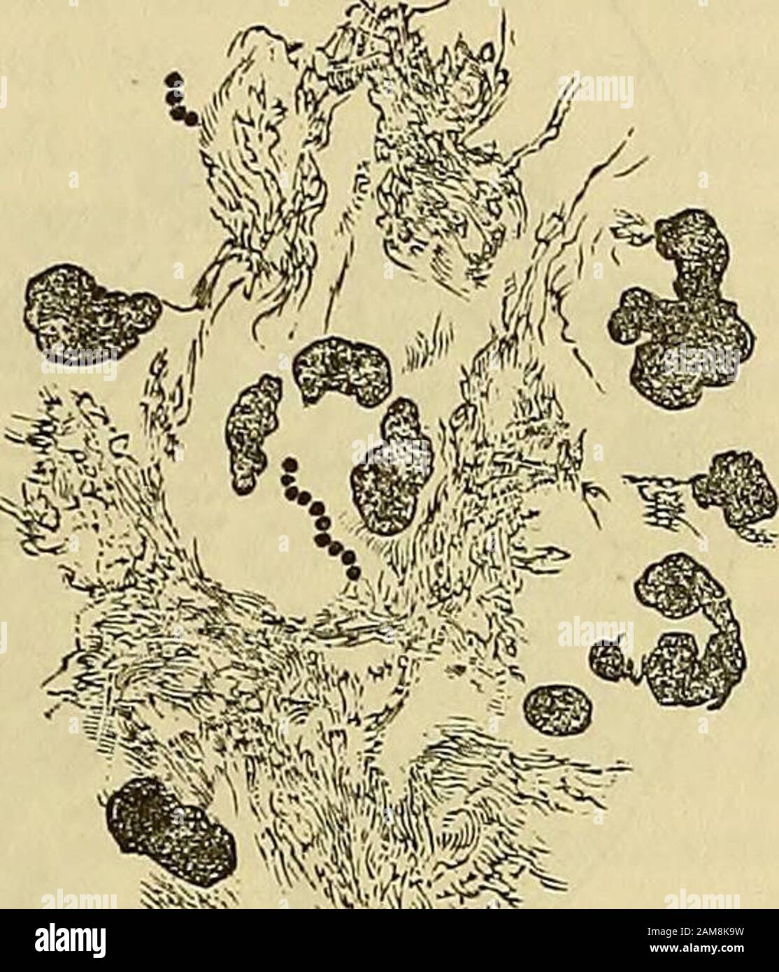 Brain abscesses hi-res stock photography and images - Alamy