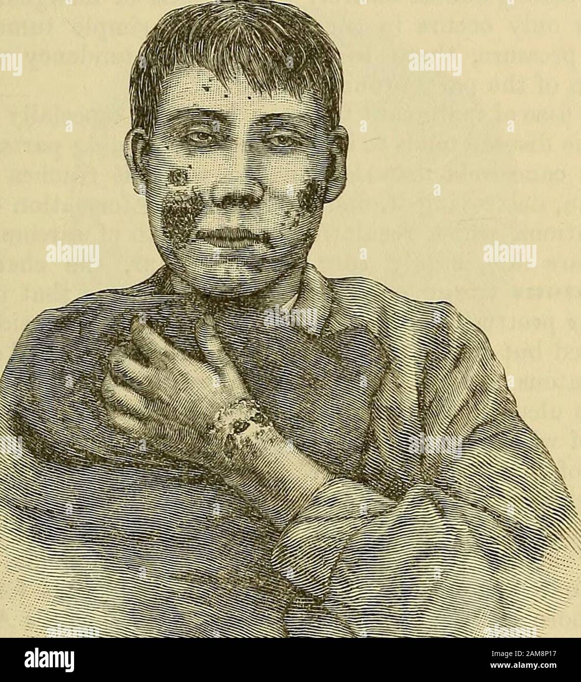 Sore th hi-res stock photography and images - Alamy