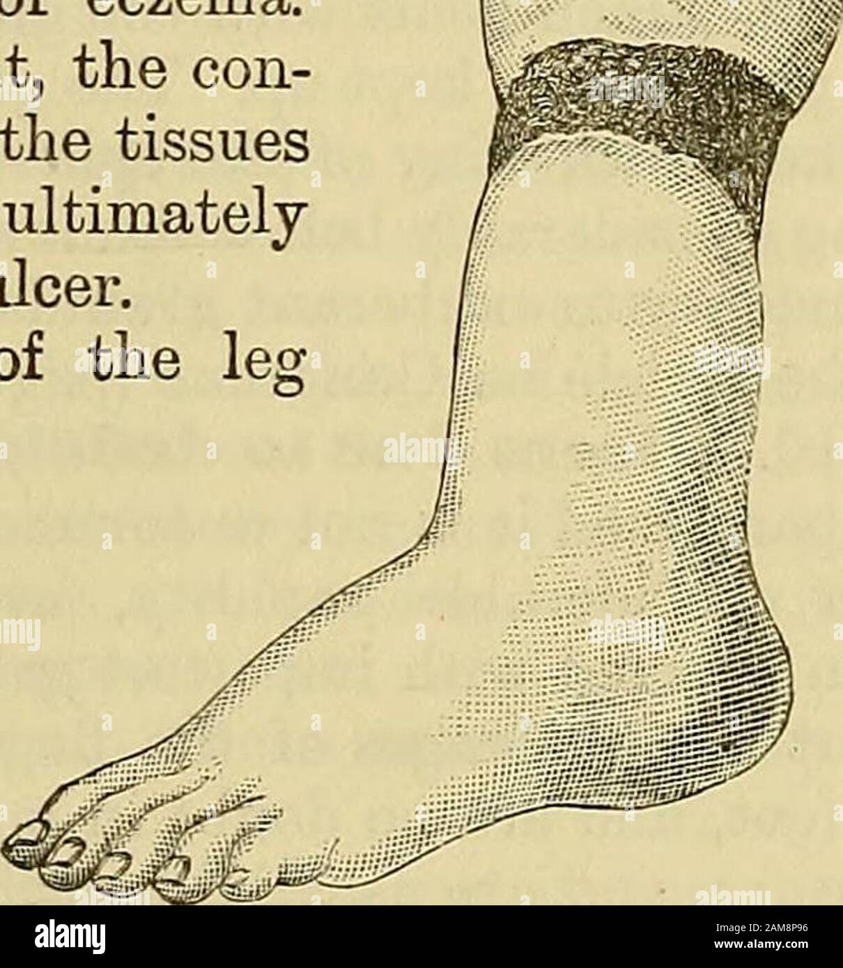 Ulcer Base High Resolution Stock Photography and Images - Alamy