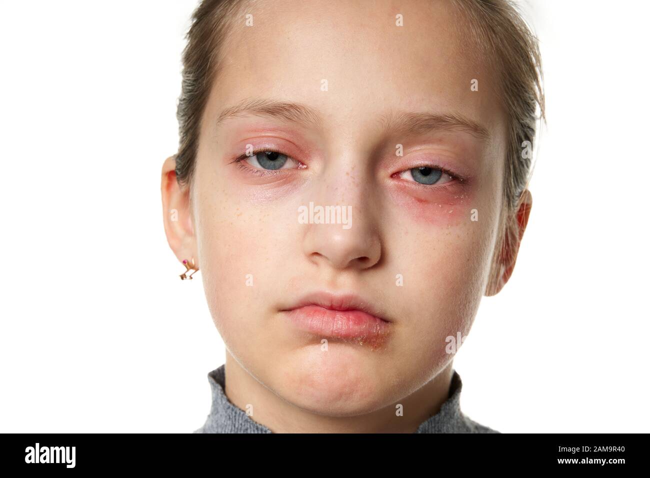 Allergic reaction, skin rash, close view portrait of a girl's face ...