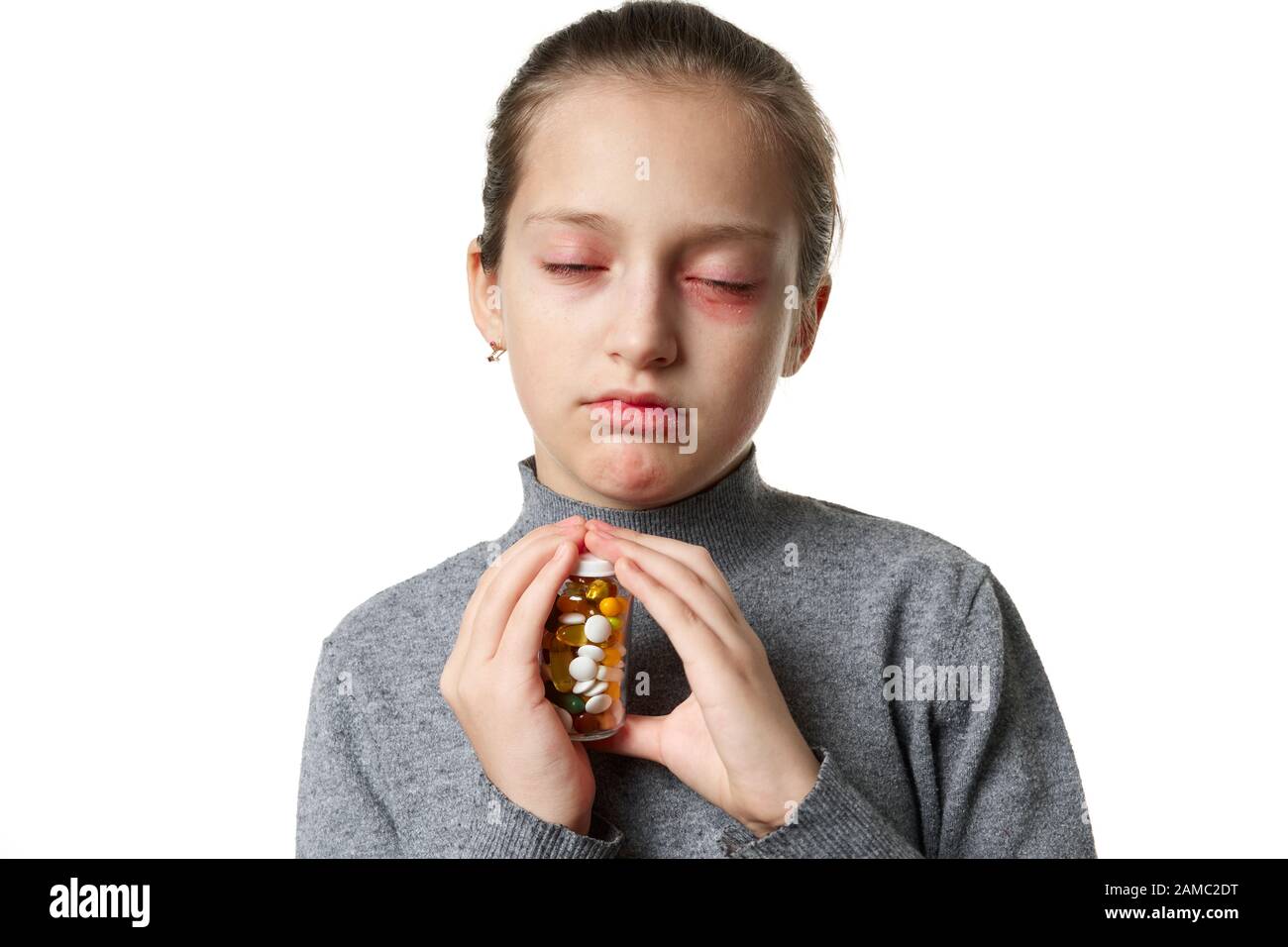 Allergic reaction, skin rash, close view portrait of a girl's face ...