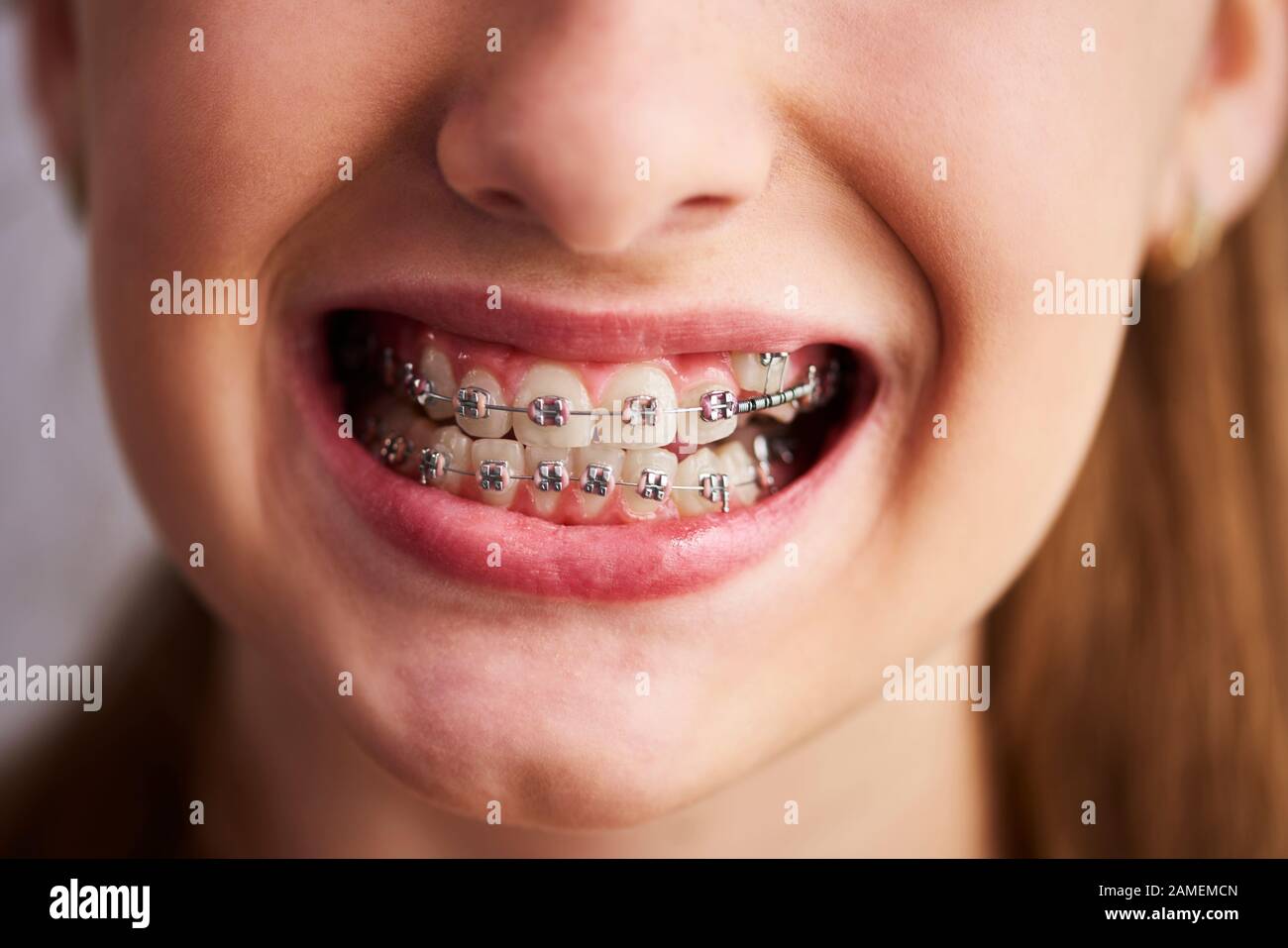 Shot of teeth with braces Stock Photo - Alamy