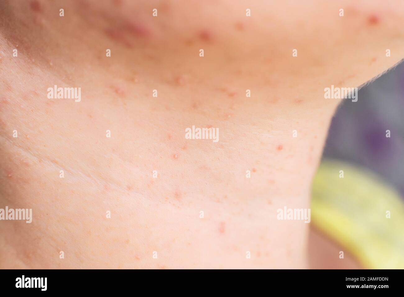 Red acne and a rash on a girl's face and neck, macro Stock Photo - Alamy