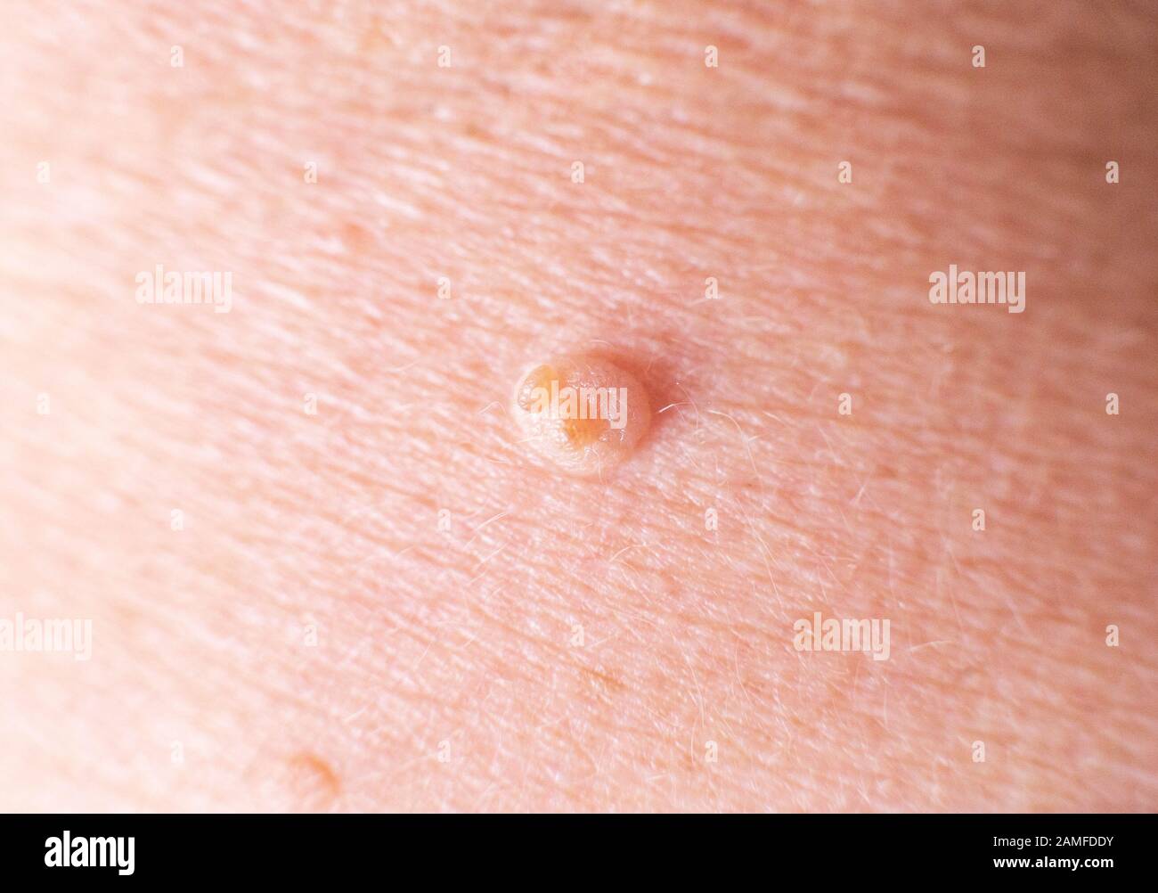 Viral wart hi-res stock photography and images - Alamy