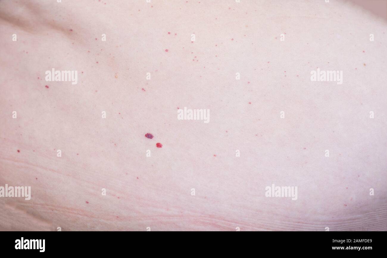 Red moles of nevi on the abdomen in humans, neoplasms Stock Photo - Alamy