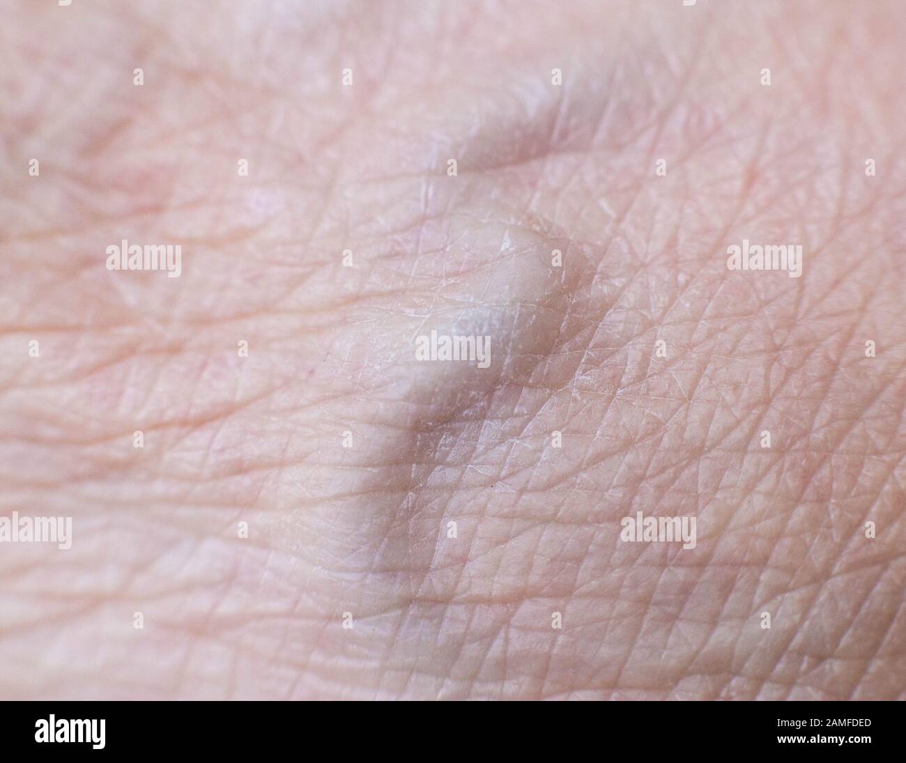 Tortuous vein hi-res stock photography and images - Alamy