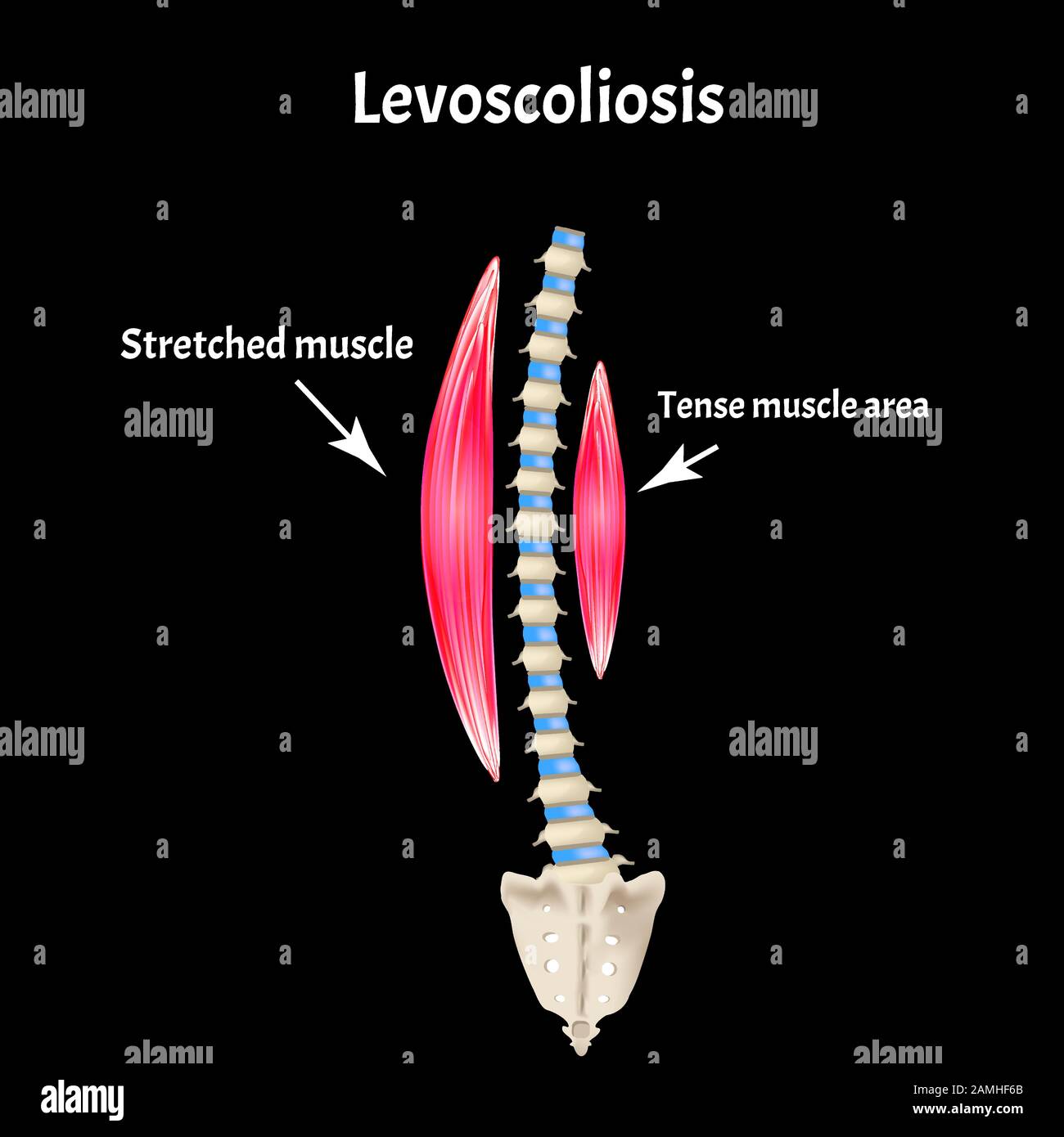 Left-sided scoliosis. Levoscoliosis. Muscles and spine. Spinal ...