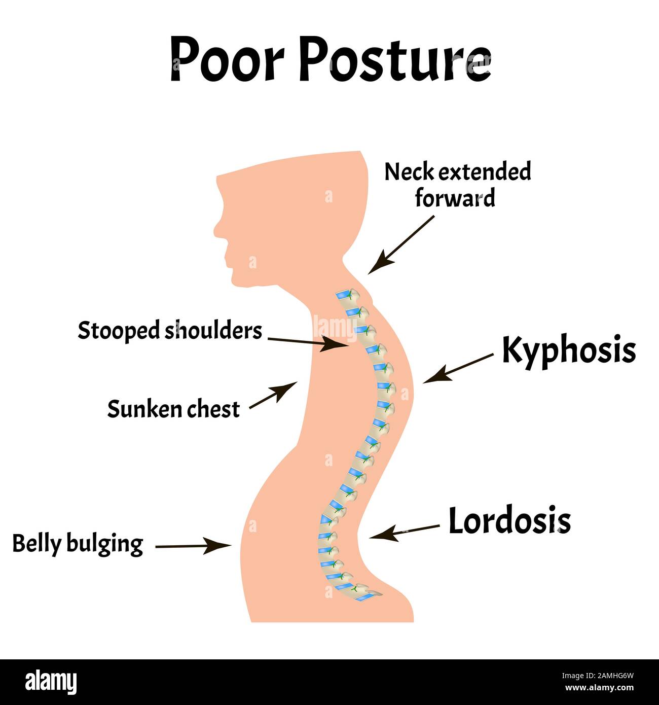 Improper posture symptoms. Text Neck Syndrome. Spinal curvature ...
