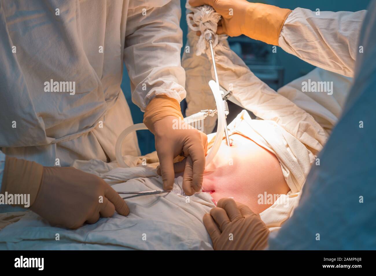 Close up of laparoscopic surgery in a sterile operating room ...