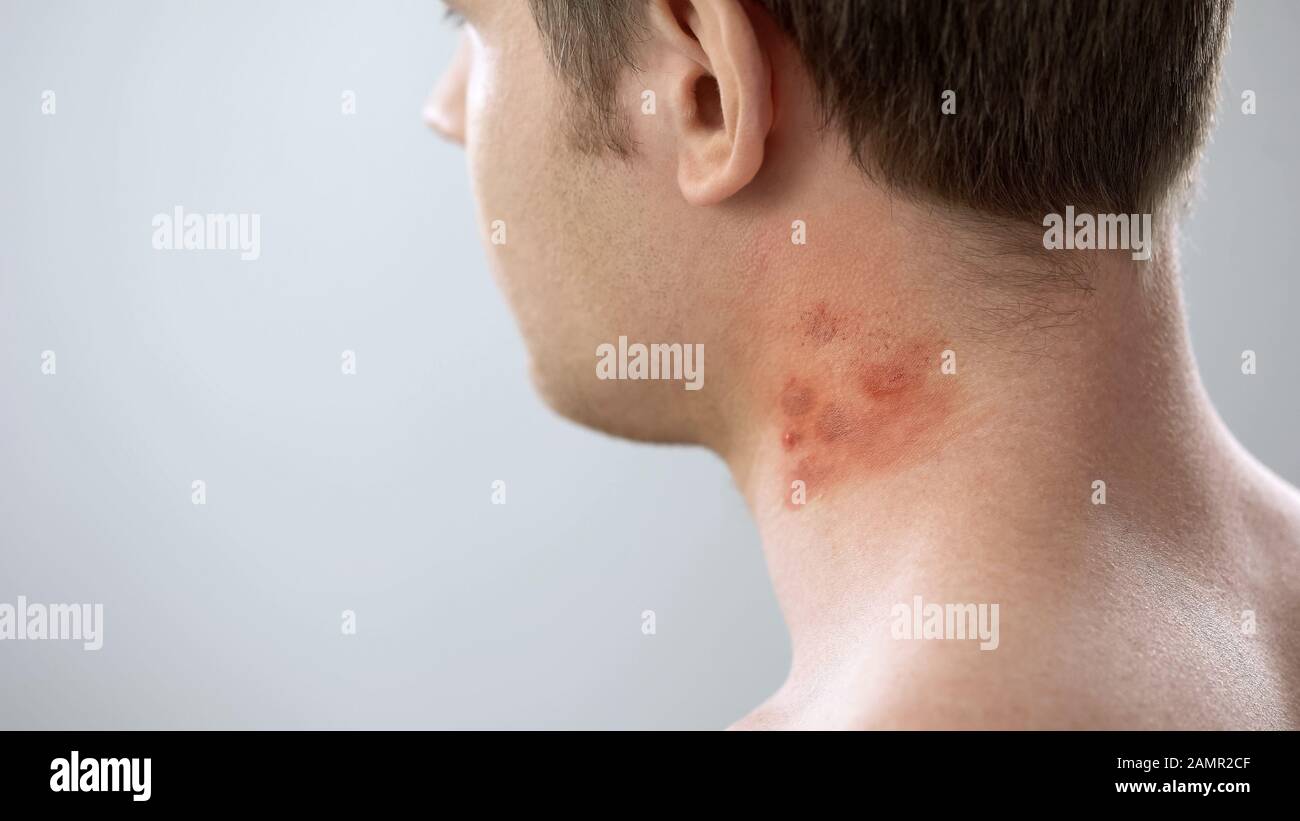 Red spots on male patient neck, bites of insects, allergy, contact ...