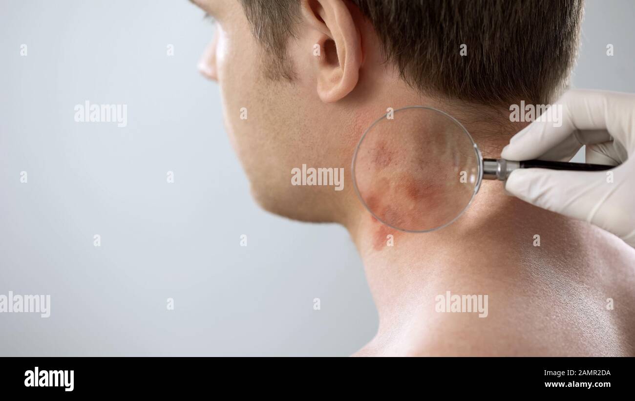 Neck skin rashes hi-res stock photography and images - Alamy