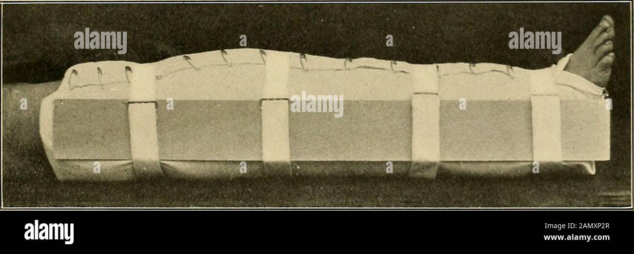 The treatment of fractures . Fig. 505.—Fracture of the leg. Pillow and ...