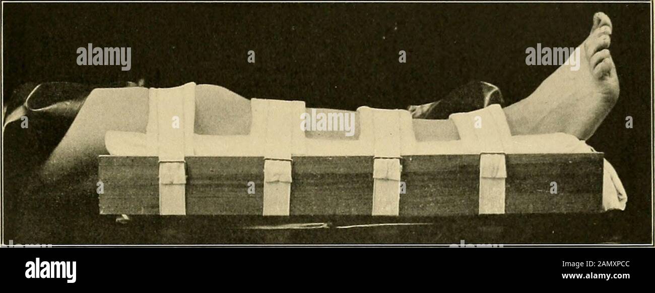 Septic leg hi-res stock photography and images - Alamy