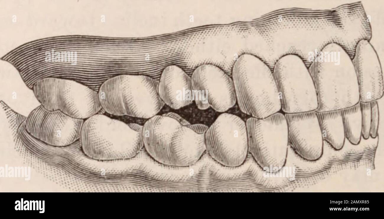 Parulis hi-res stock photography and images - Alamy