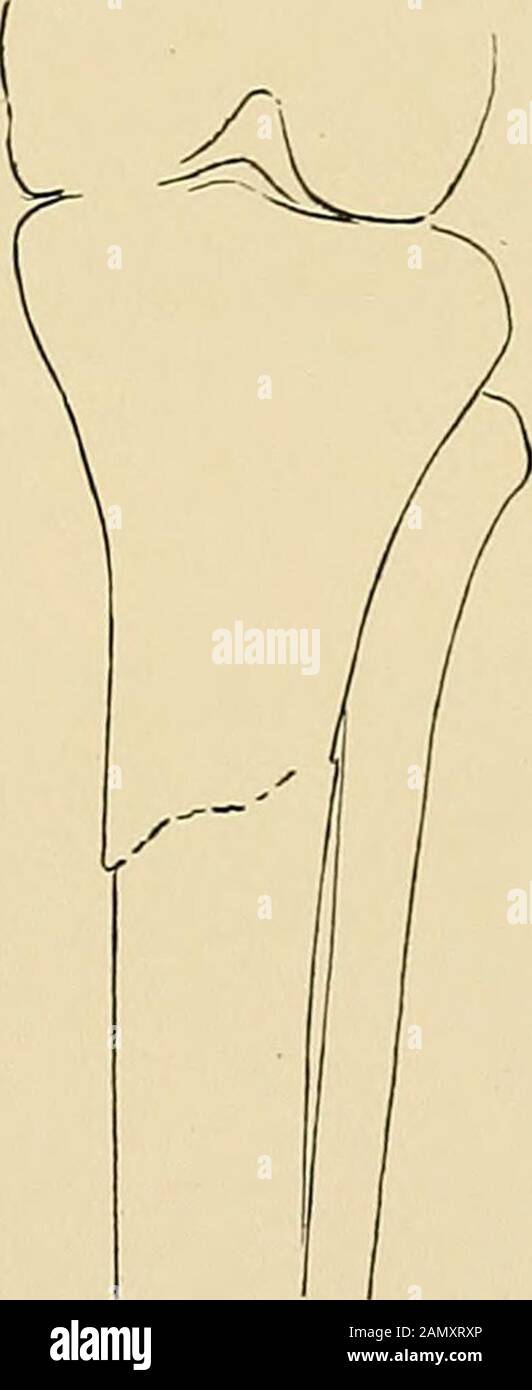 The treatment of fractures . Fig. 501.—Fracture of both bones ofthe leg ...