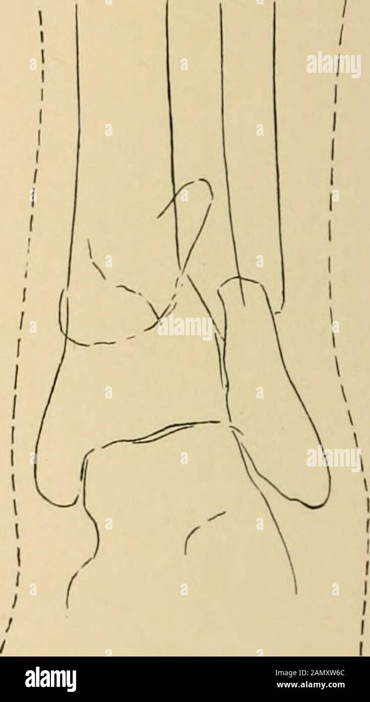The treatment of fractures . Fig. 499.—Fracture of the fibula lowdown ...