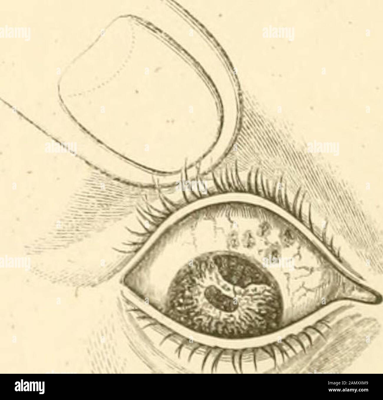 A treatise on the diseases of the eye . 51 DESCRIPTION OF PLATE X. Figs ...