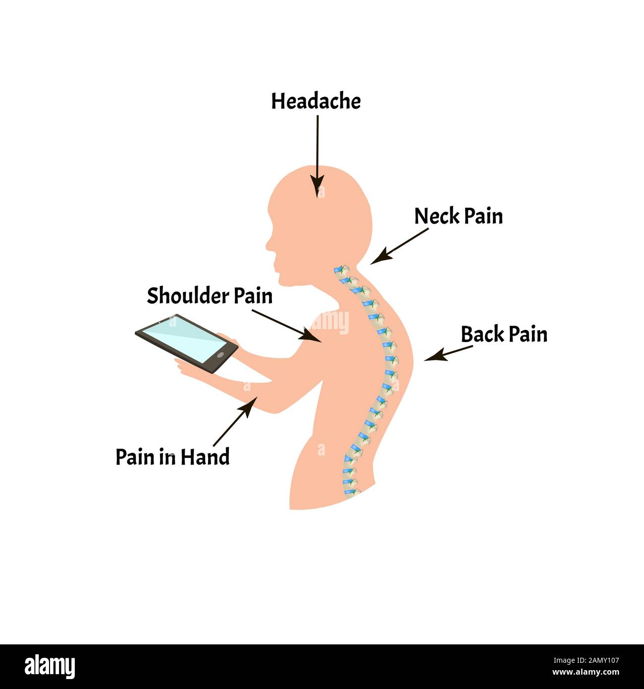 Improper posture symptoms. Text Neck Syndrome. Spinal curvature ...