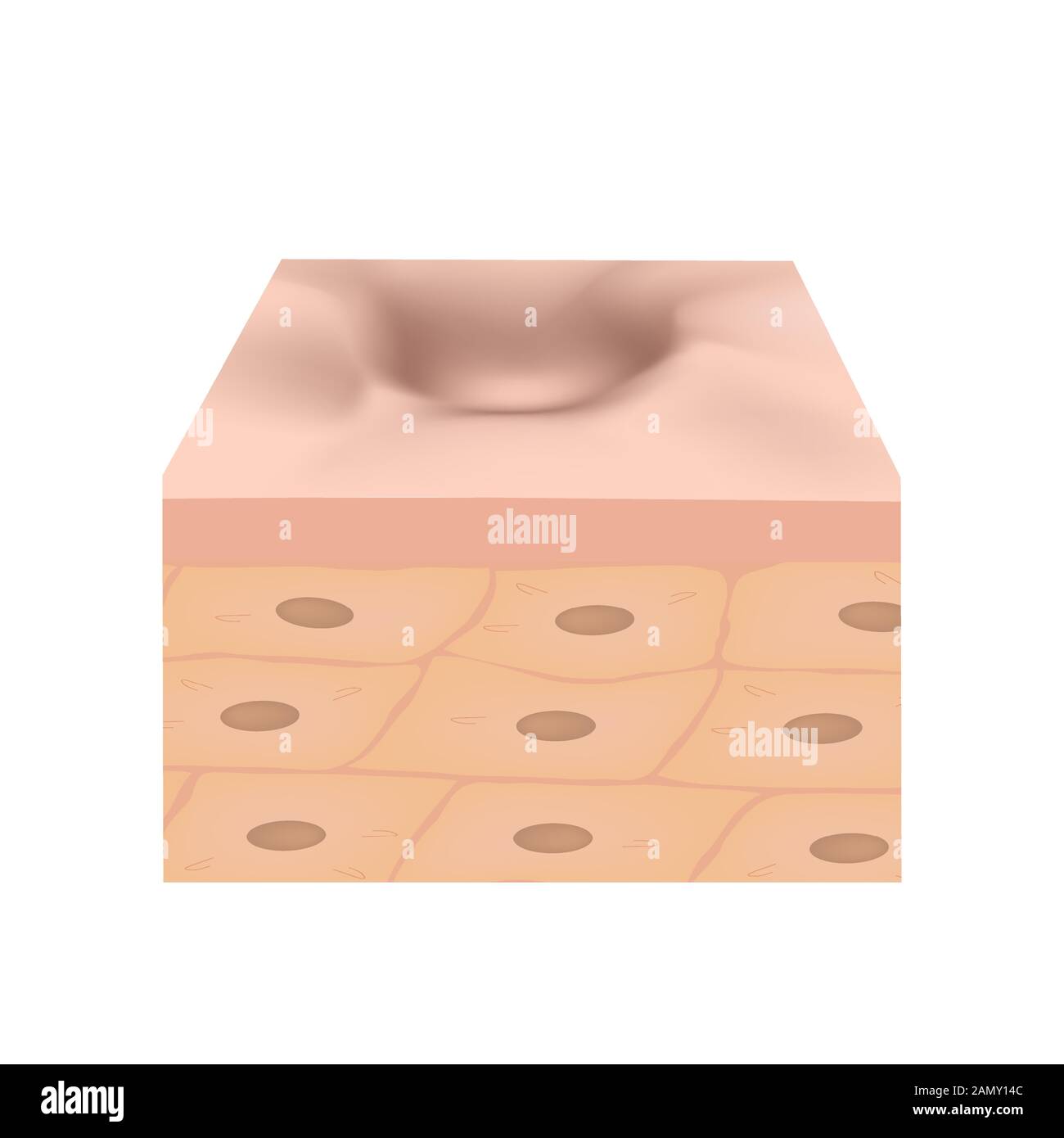 Atrophic scars. Acne scar. The anatomical structure of the skin with ...