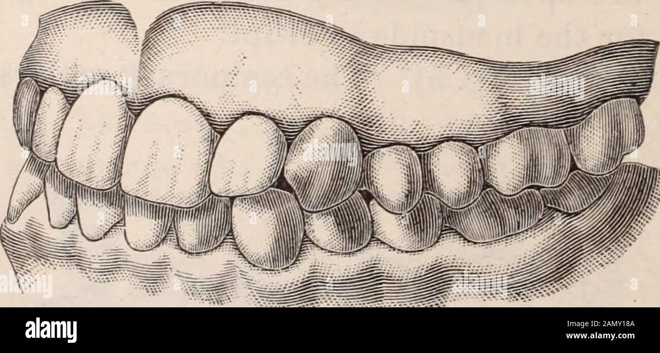 Dental cosmos . the occlusion of the lower incitsors prevented from ...