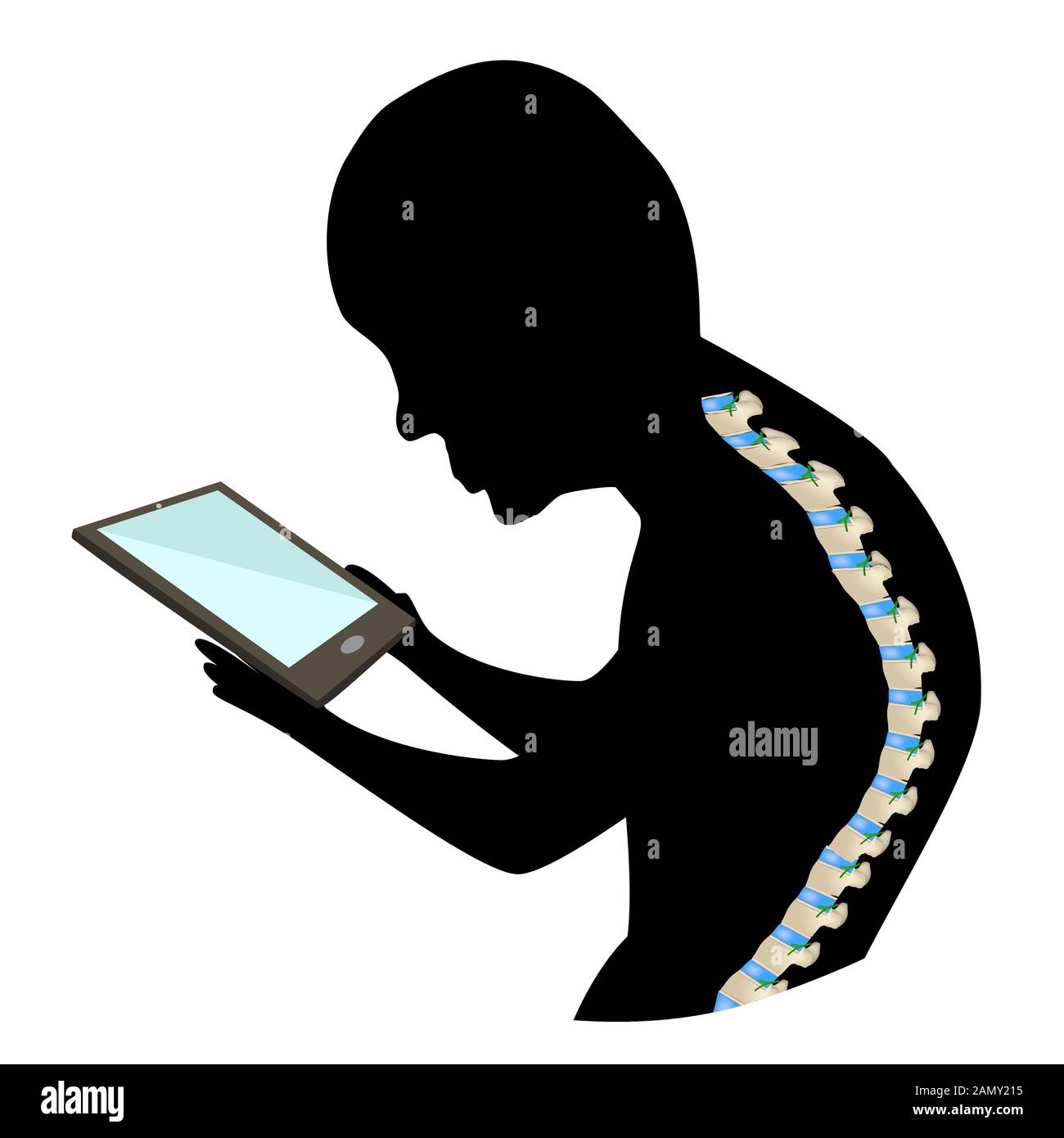 Text Neck Syndrome. Spinal curvature, kyphosis, lordosis of the neck ...