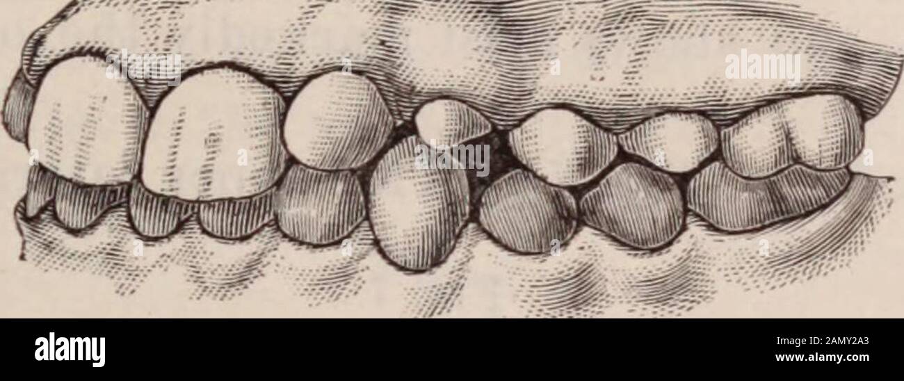 Permanent molars hi-res stock photography and images - Alamy