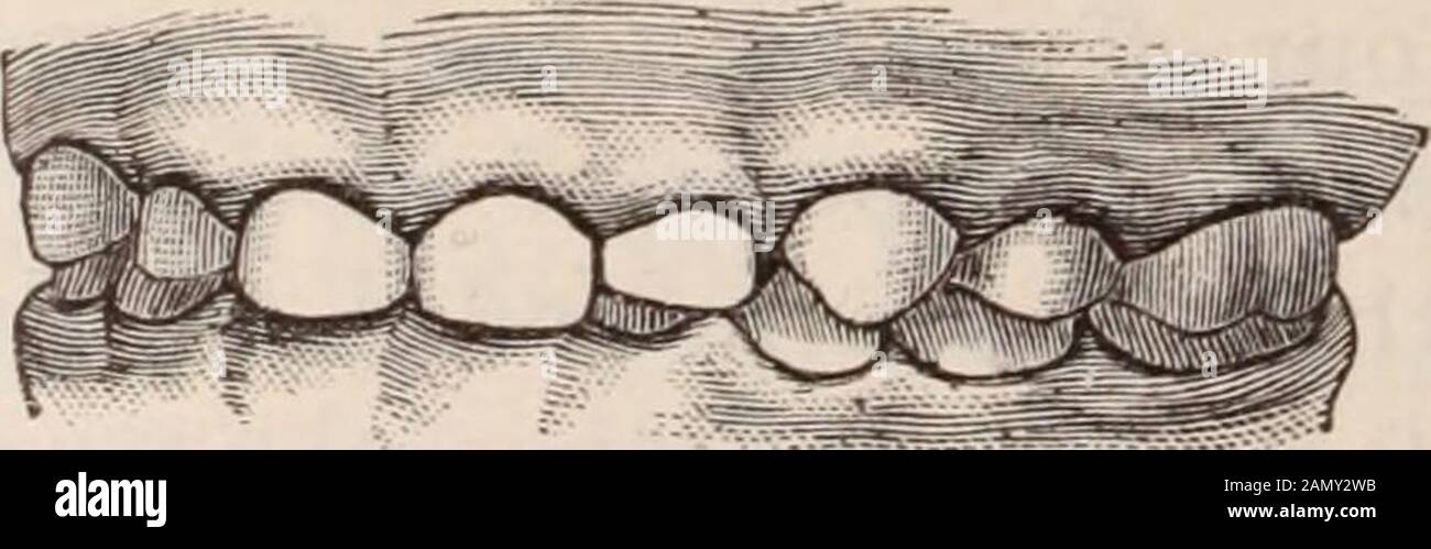 Dental cosmos . age (Fig. 1). The twenty temporary teeth are all in ...