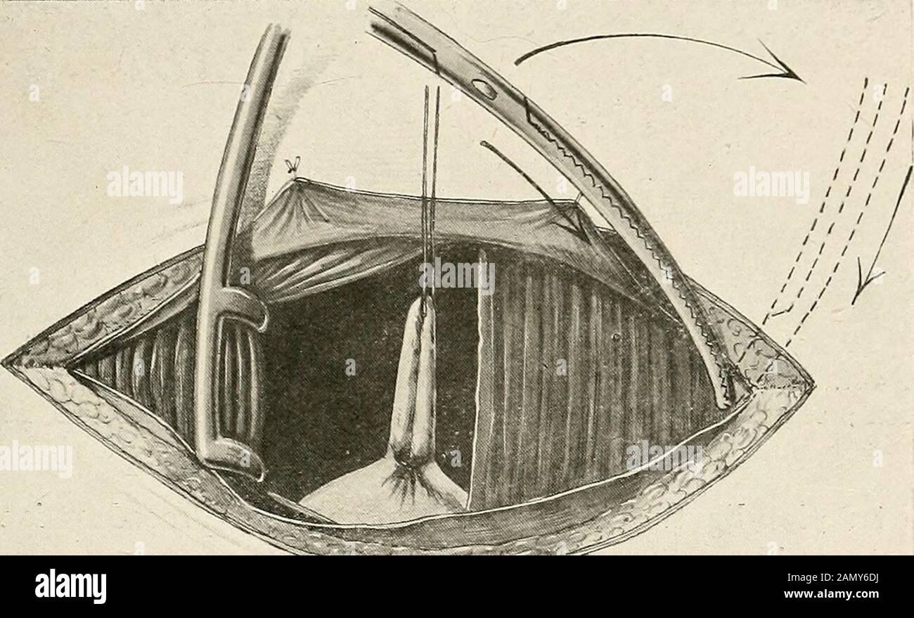Round ligament of uterus hi-res stock photography and images - Alamy