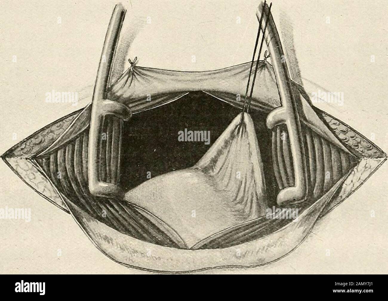 Uterus Round Ligament Attachment Is it possible for the ovary to ...