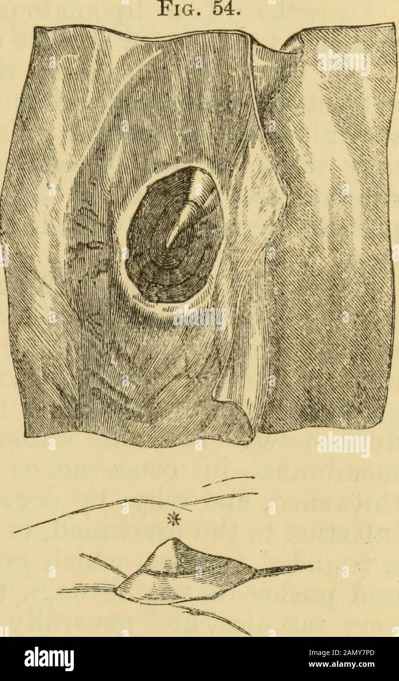 Arachnoid Membrane High Resolution Stock Photography and Images - Alamy