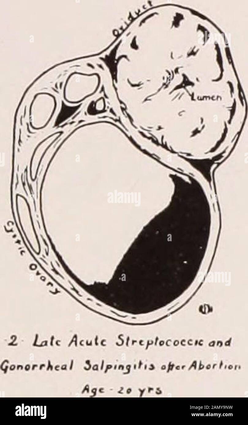 Purulent Exudate Teeth