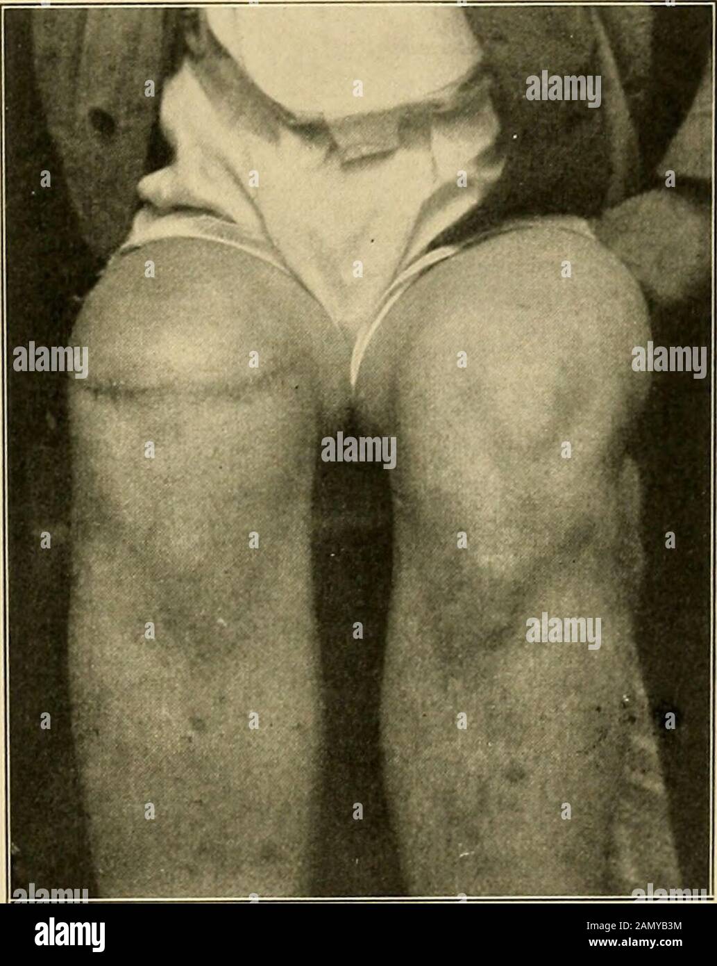 Knee amputation hi-res stock photography and images - Alamy