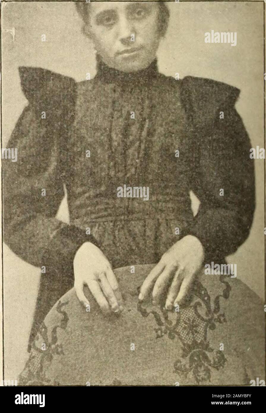 Rickets child hi-res stock photography and images - Alamy