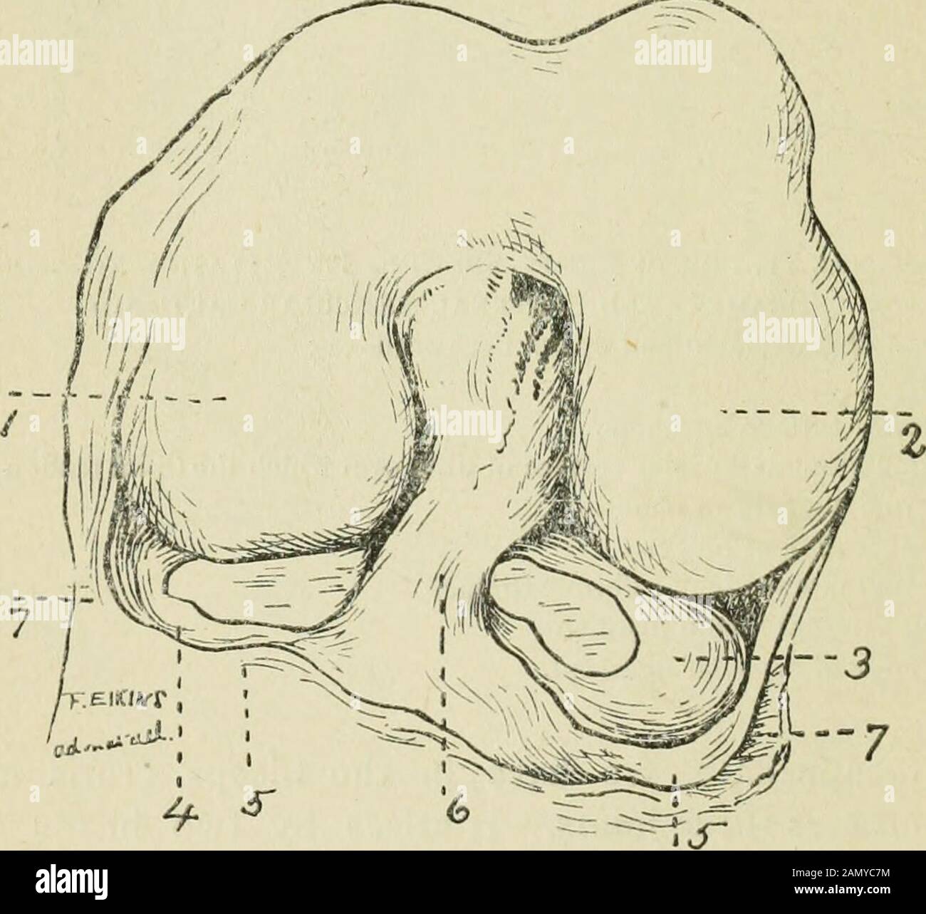 Annals of surgery . Fig. III.—Interior of Knee-Joint.Quadriceps ...