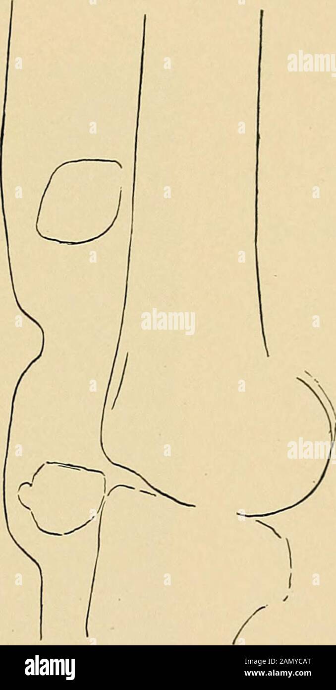 The treatment of fractures . Fig. 472.—Old fracture of patella ...