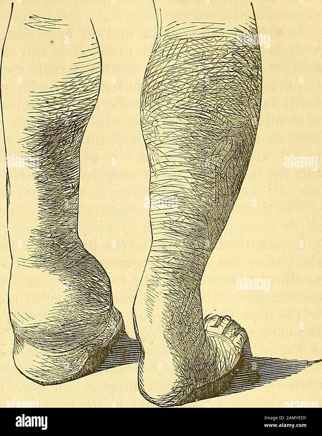 Partially dislocated hi-res stock photography and images - Alamy