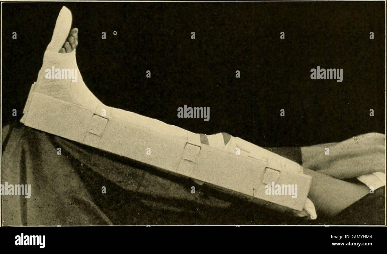 Treating fracture hi-res stock photography and images - Alamy