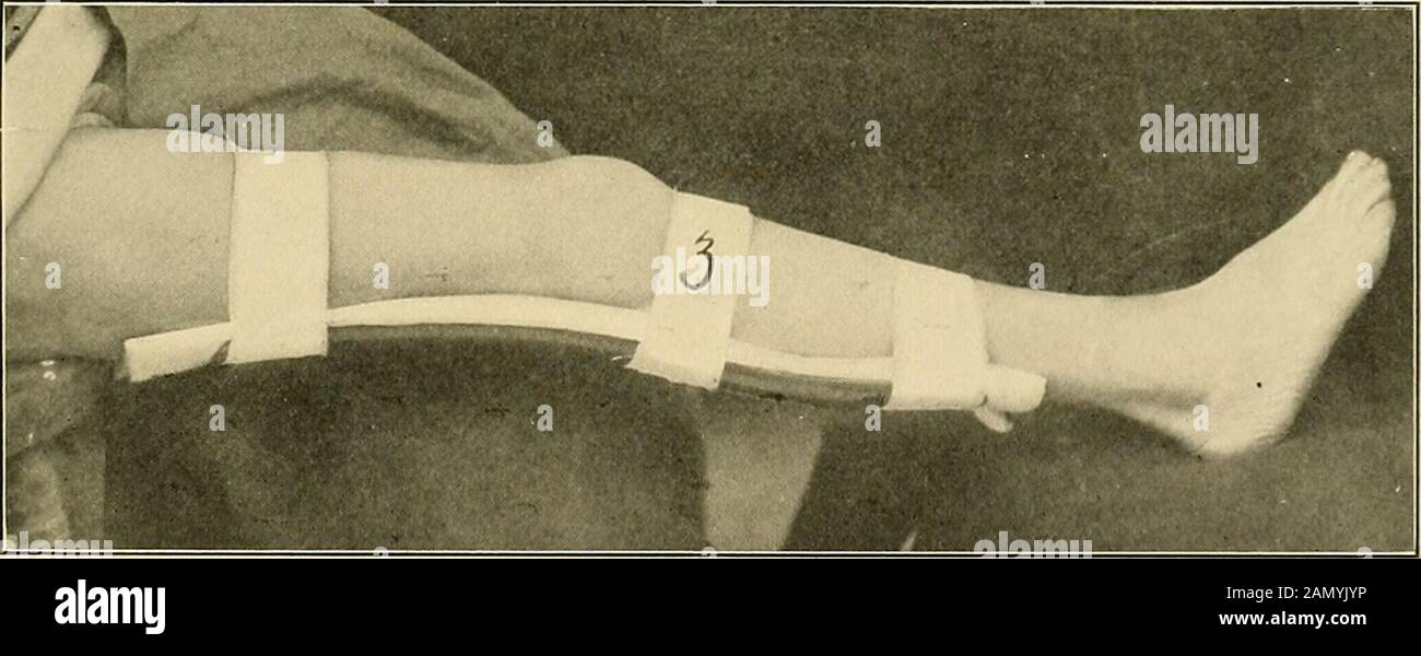 The treatment of fractures . Fig. 457.—Improper method of applyng a ham ...