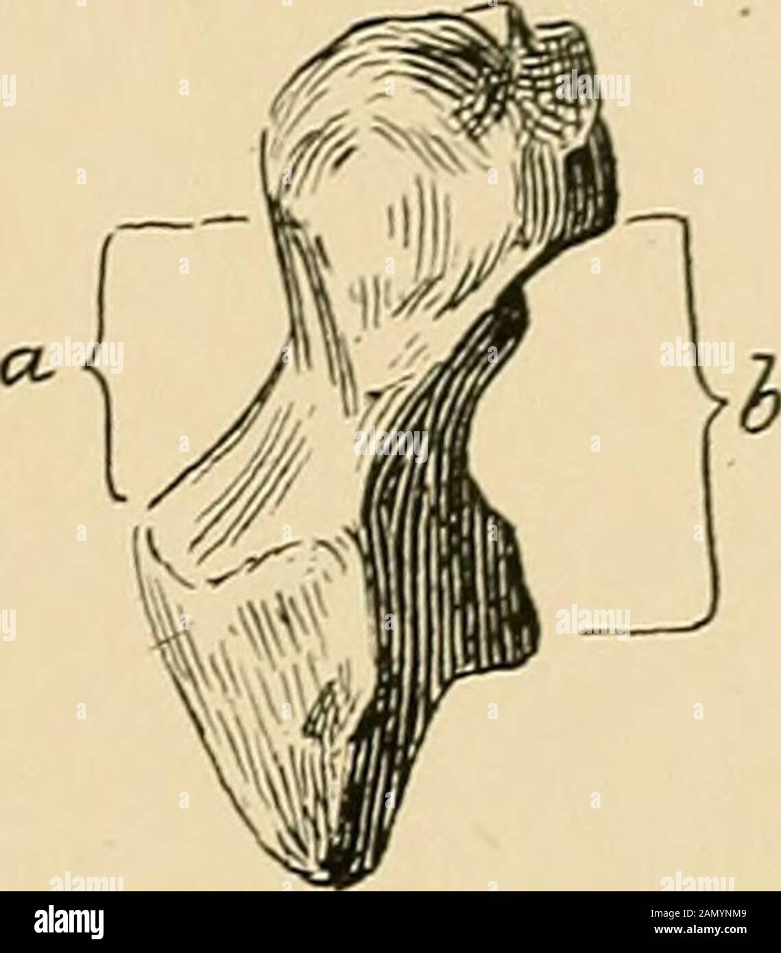 The treatment of fractures . Fig. 451.—Fracture of patella ...
