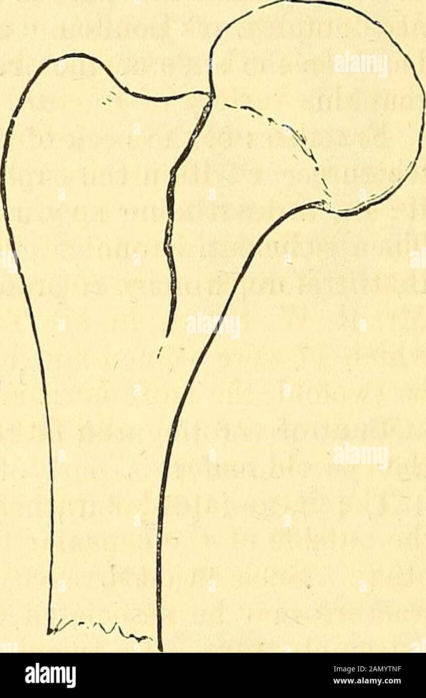 Trochanter Roll Placement