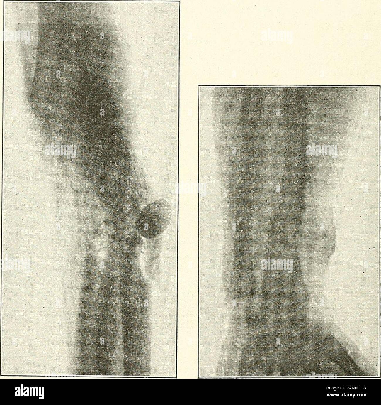 Gunshot injuries : how they are inflicted : their complications and ...