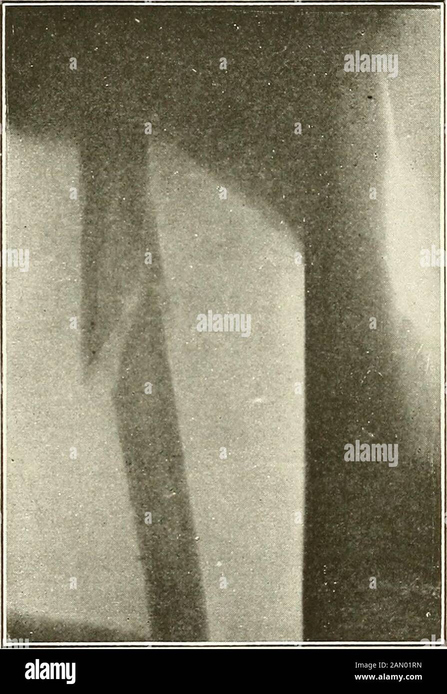 Gunshot injuries : how they are inflicted : their complications and ...