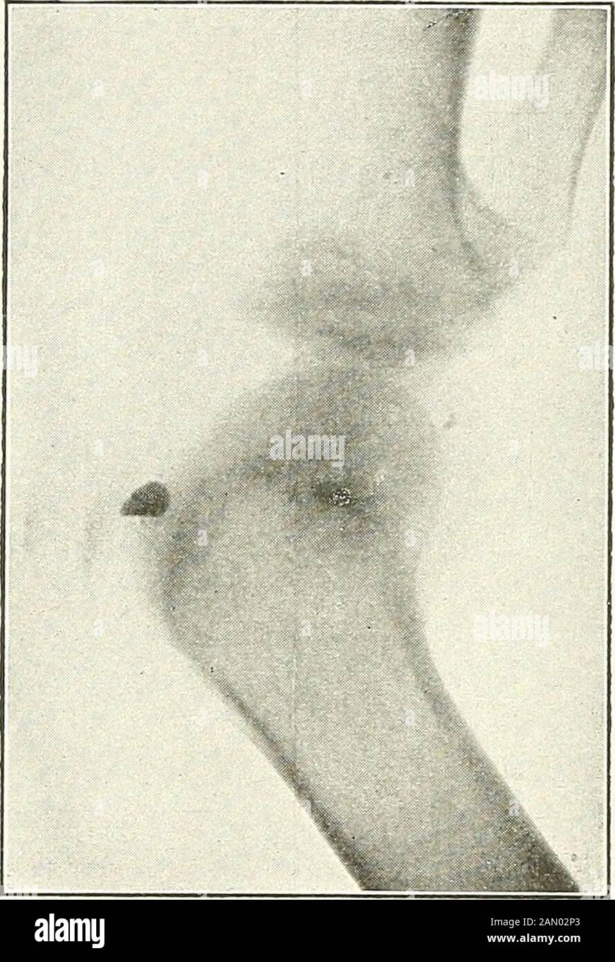 Gunshot injuries : how they are inflicted : their complications and ...