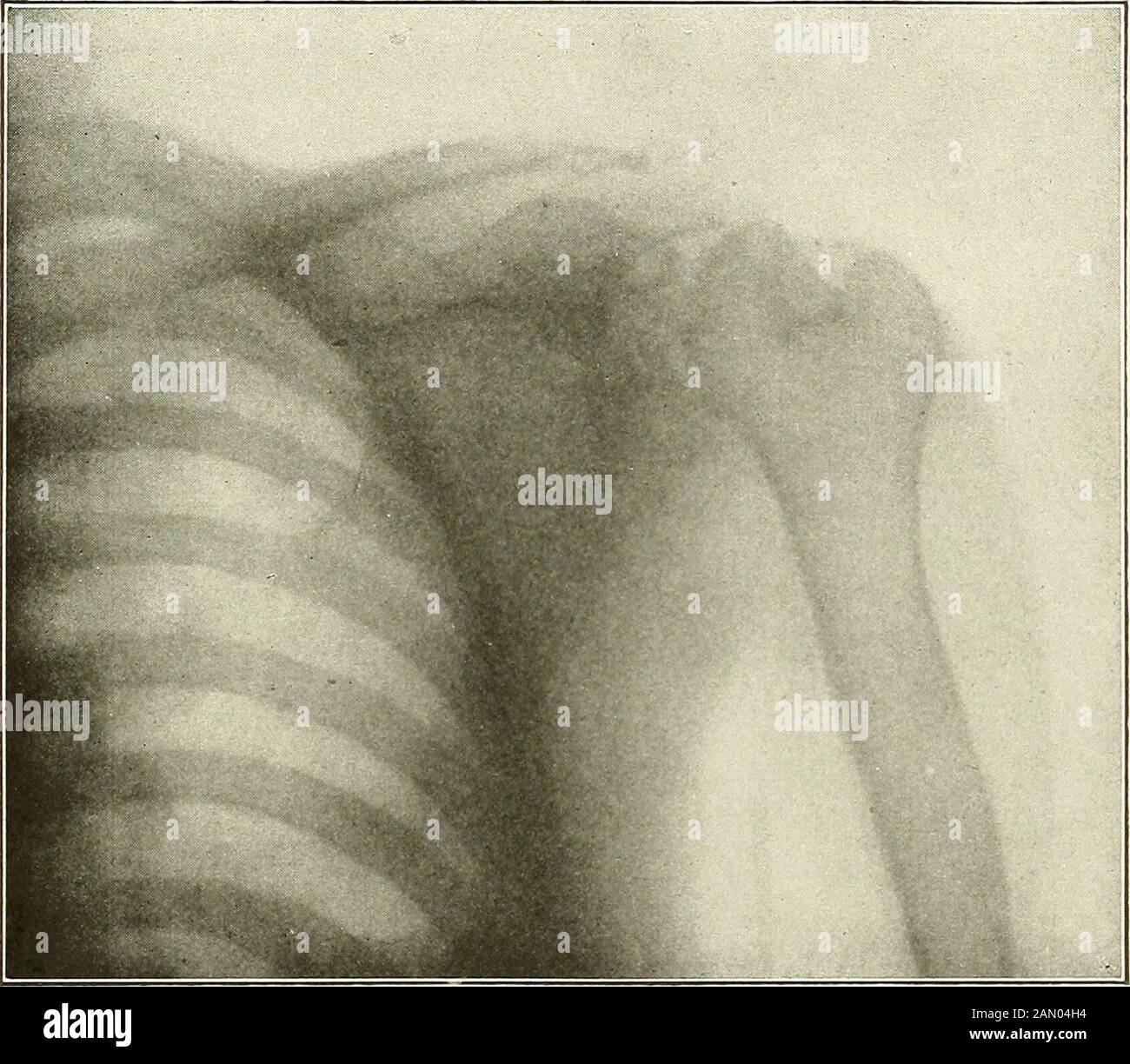 Shrapnel injuries hi-res stock photography and images - Alamy